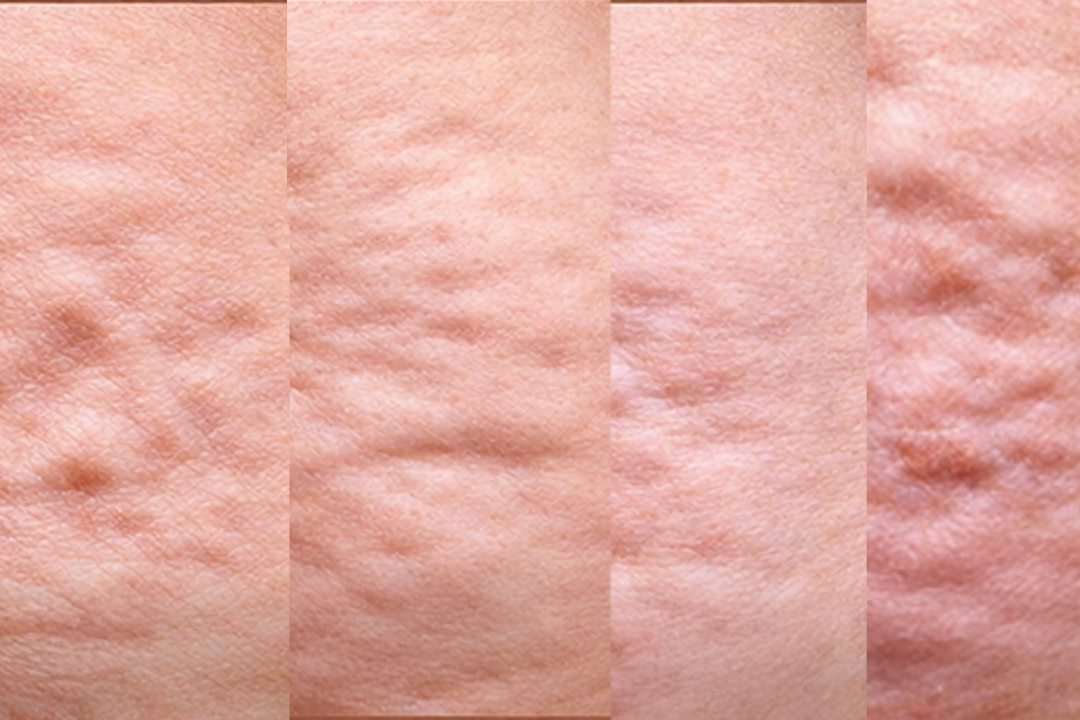 Tipos de celulitis: cómo identificarla y mejorar tu piel – Emily Cosmetic